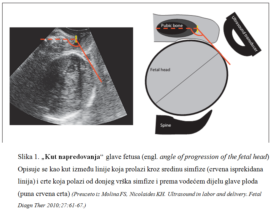 "Smjer glave" (engl. "head direction") je kut između infrapubične ...