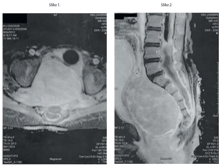 Tumorski markeri iznosili su: neuron specifična enolaza 105,9; feritin ...